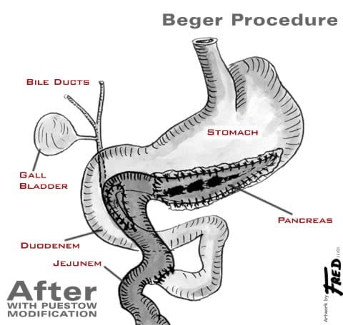 Beger Procedure | MUSC Health | Charleston SC
