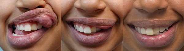 Vascular Anomalies Services at MUSC | MUSC Health | Charleston SC